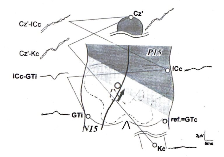 体性感覚誘発電位（SEP：somatosensory evoked potentials） – NeuroNote / ニューロノート